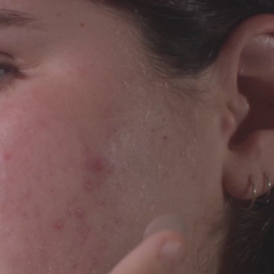 Etto Australia: Acne Micro-dart Patches – ettoaustralia